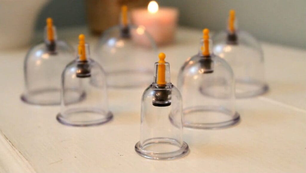 Cupping (Hijama) Treatment in Riyadh - KSAexpats.com